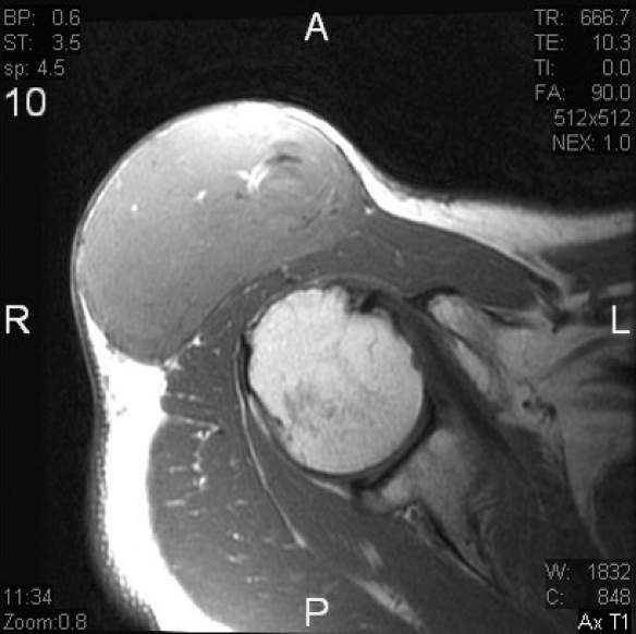 Dermatofibrosarcoma Protuberans - Jacobs School of Medicine and ...